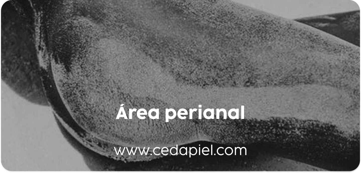 Depilación Láser en el Área Perianal | Higiene y comodidad | Cedapiel