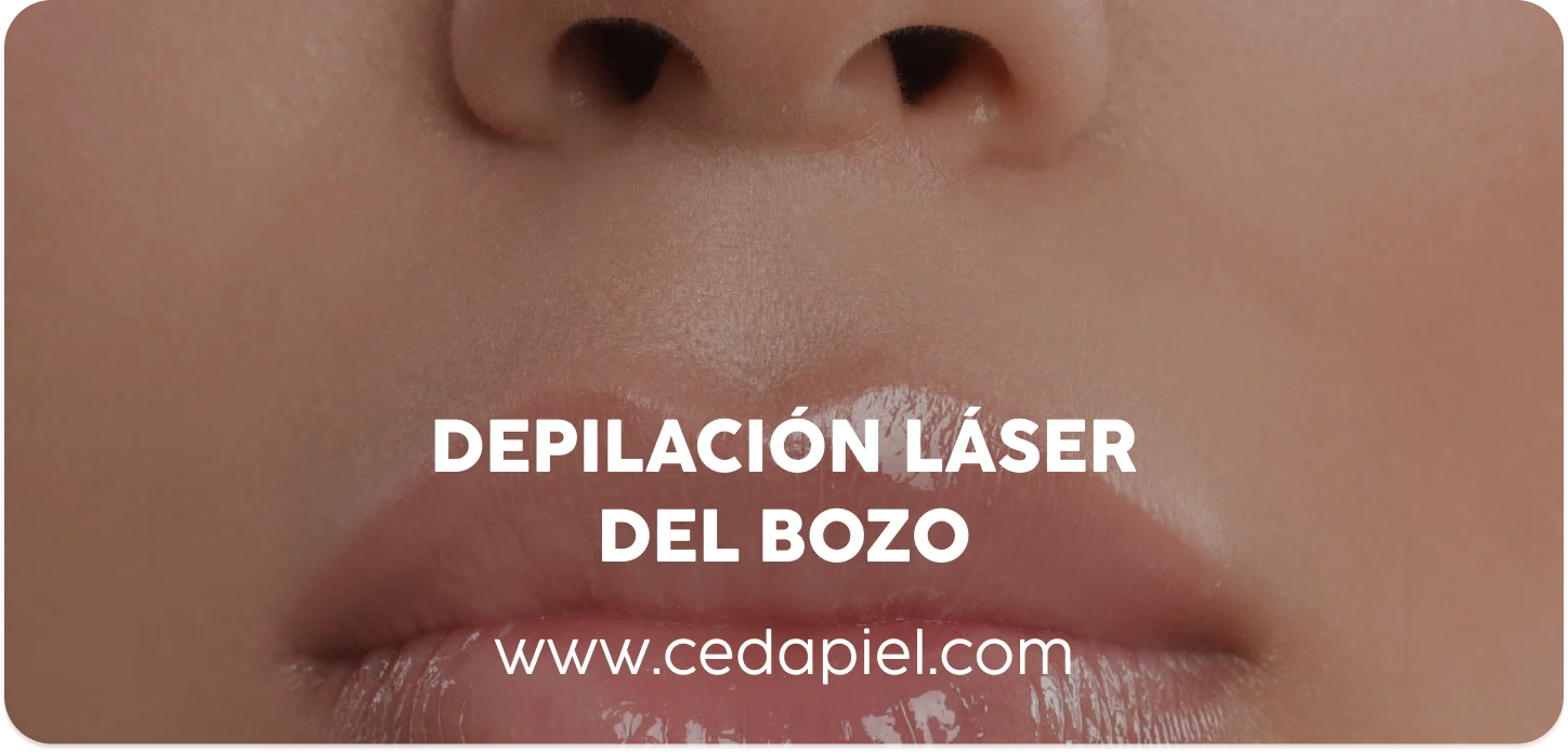 Depilación láser del bozo - Cedapiel | Expertos en depilación láser y ...